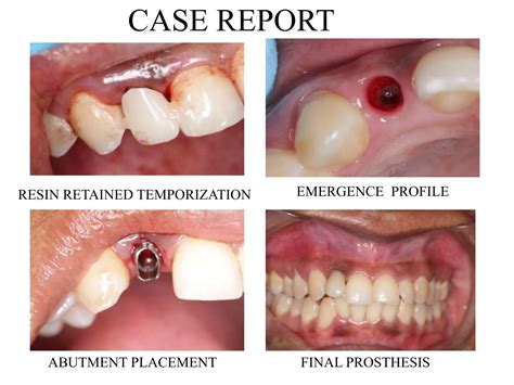 socket shield technique pptx dental health diseases and conditions
