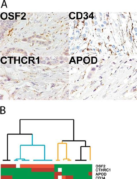 Fibroblast Markers In Breast Carcinoma A Examples Of Sft Apod [ish