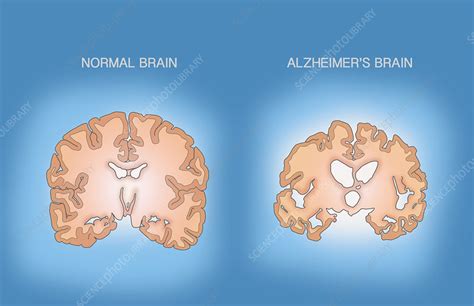 Alzheimers And Normal Brains Comparison Stock Image F0318272