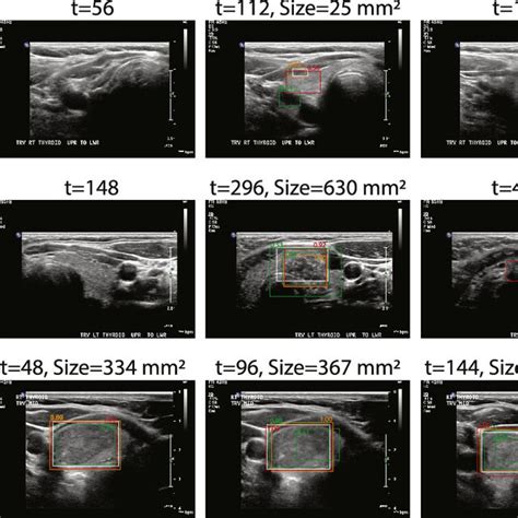 Examples Of Nodule Detection Results In Ultrasound Video Sequences