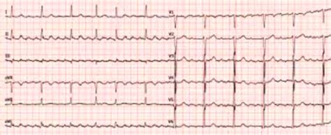 Atrial Flutter Afl Af Ablation