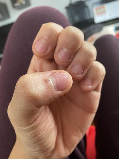 Progress After 2 Months Of Biab Swipe For Before Chronic Nail Biter For 25 Years Not Much