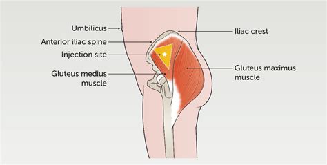 Is A Inch Needle Safe For An Im Injection In Glute Muscle 46 Off