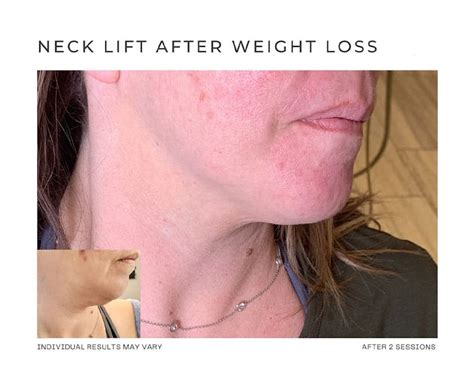 Patient 146528386 Before And After Fibroblast Genesis Lifestyle Medicine