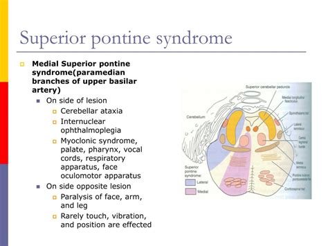Medial Pontine Syndrome