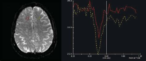 Comparative Analysis Of The Perfusion Curve In The Region Of The Lesion