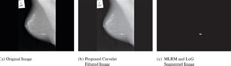 Figure 1 From Breast Cancer Detection Using Combined Curvelet Based Enhancement And A Novel