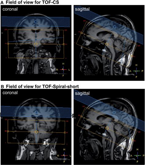 Female Patient With Vertigo And Ataxia Undergoing Mri Including
