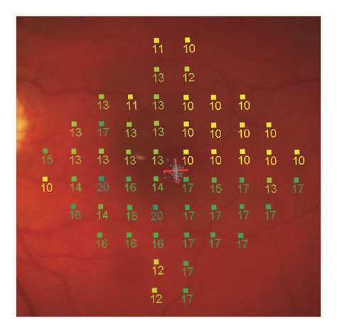 A Etdrs Chart For Best Corrected Visual Acuity Test B Macular