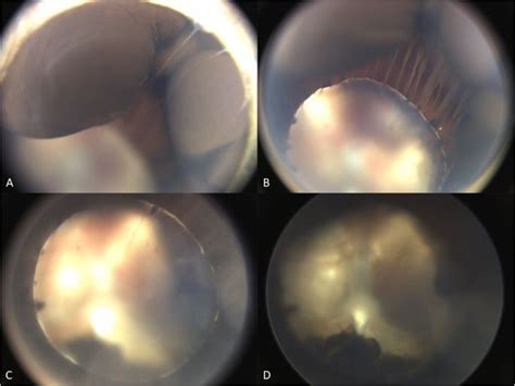 Microphthalmos With A Myriad Of Anterior And Posterior Segment
