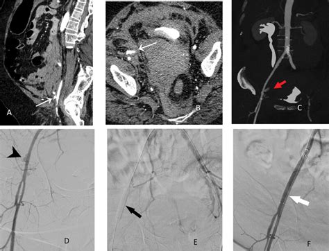 Retroperitoneal Bleeding High Puncture In The Distal External Iliac
