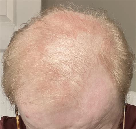 Routine Help Reduce Redness On Scalp Been Using Nizoral For Months To No Effect R
