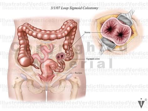 Loop Colostomy