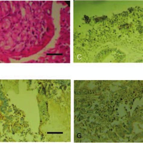Pathology Evaluation Of A 51 Yr Old Female Patient With Intrahepatic Download Scientific
