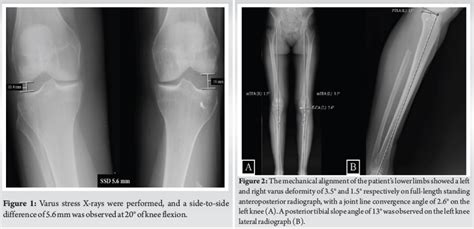 Tibial Based Posterolateral Corner Reconstruction Following Proximal Fibula Resection Restores
