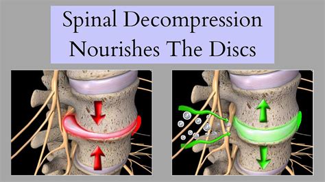 Spinal Decompression Circle Chiropractic
