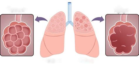 ფილტვის ემფიზემას სამკურნალო ხალხური ეფექტური რეცეპტები სასარგებლო რჩევები