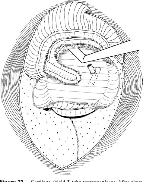 Figure 23 From Cartilage Tympanoplasty Methods Proposal Of A Classification Semantic Scholar