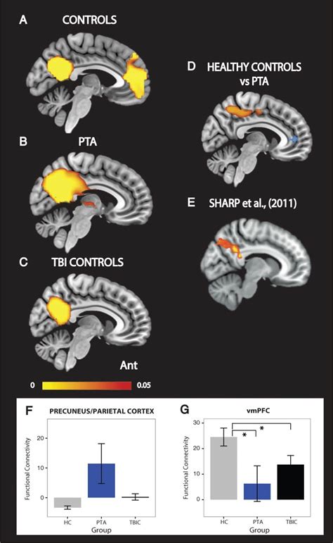 Functional Connectivity Within The Dmn Functional Connectivity Of The