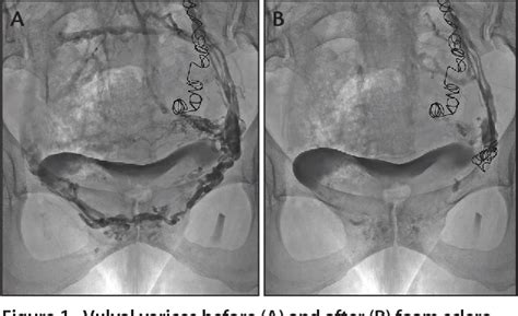 Figure 1 From Embolization For Pelvic Congestion Syndrome Semantic