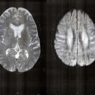 A Pml Gross Pathology Finding Right Frontoparietal White Matter