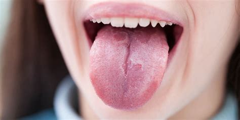 How Dehydration Affects Your Tongue Signs Symptoms And Solutions