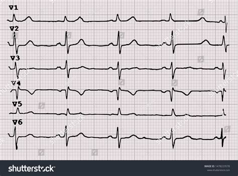 Cardiogram Heartbeat Graph On Graph Paper 스톡 일러스트 1478223578