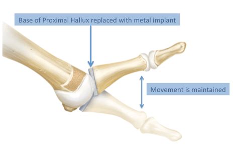 Big Toe Arthritis Hallux Rigidus The London Foot And Ankle Clinic