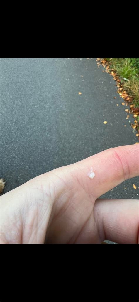 Thick White Glue Mucus From Nose R Sinusitis