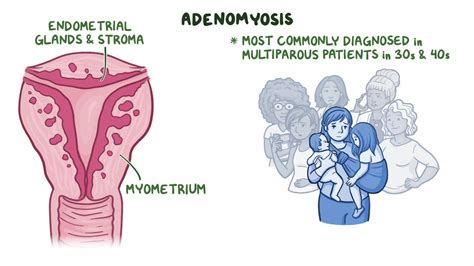 Adenomyosis Video And Meaning Osmosis