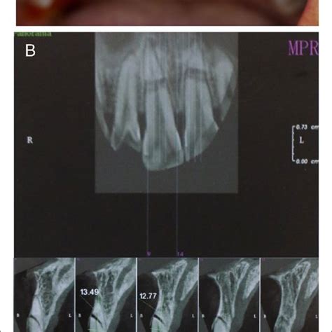 Embryonic Bone Development A Intramembranous Bone Formation B Download Scientific Diagram