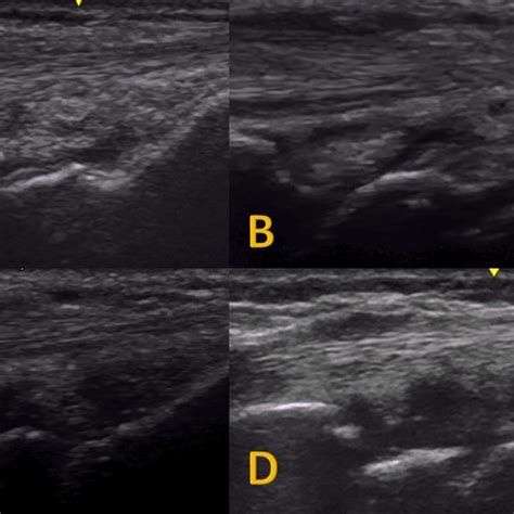 Gray Scale Ultrasound Grading Of Synovitis Download Scientific Diagram