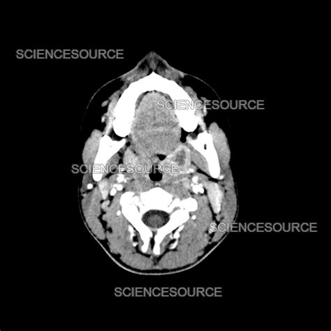 Photograph Ct Of Tonsillar Abscess Science Source Images