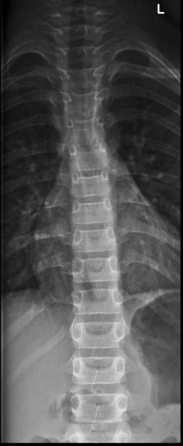 Thoracic Spine Xray