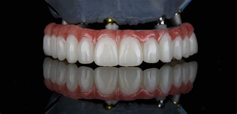 Dental Implants Katy Lakes Dentistry