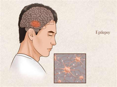 Epilepsy And Acupuncture Treatment