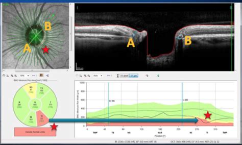Oct And Glaucoma Flashcards Quizlet