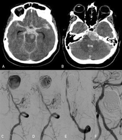 Cerebral Aneurysms At Major Arterial Bifurcations Are 49 Off