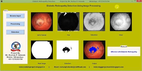 diabetic retinopathy detection using matlab project source code
