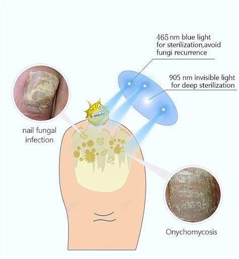 Supply Toenail Fungus Laser Therapy Device New Nail Cleaning Laser