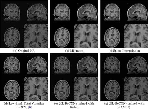 Figure 14 From Multiscale Brain Mri Super Resolution Using Deep 3d