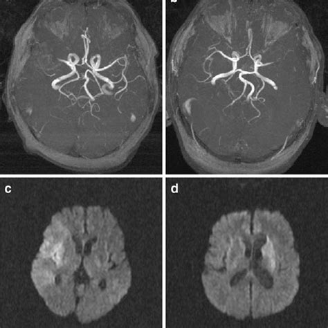 The Temporal Evolution Of Mri Parameters From Previous Stroke Studies