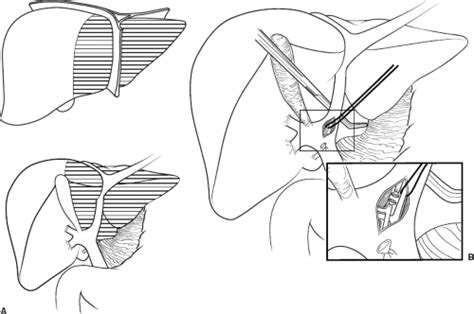 Major Hepatic Resection Basicmedical Key