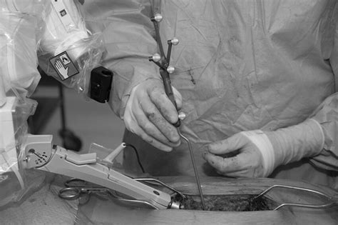 intra operative photo depicting the use of a passive planar probe to