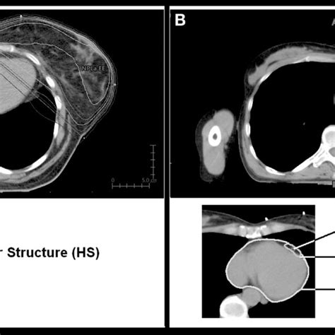 Isodose Distribution And Contouring Of Organs At Risk Depicted Are The Download Scientific