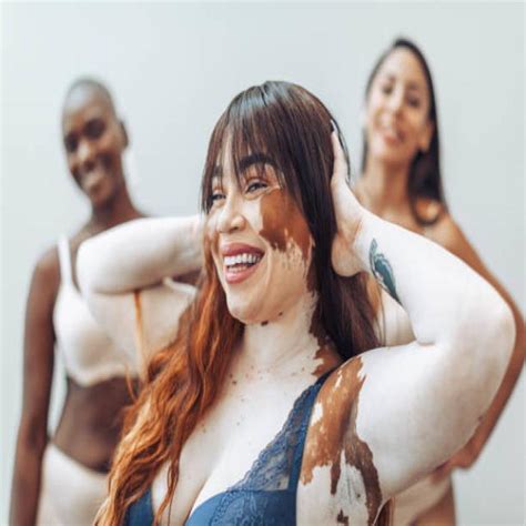 Vitiligo1 Instance Segmentation Dataset And Pre Trained Model By