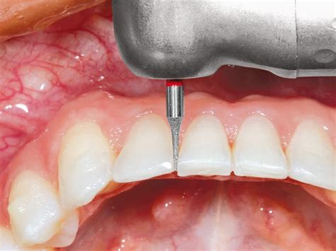 Orthodontic Interproximal Reduction Ipr Burs And Instruments Premium Quality From Komet