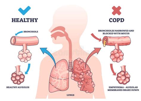 Copd Or Chronic Obstructive Pulmonary Disease Explanation Outline Diagram Stock Vector