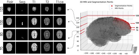 Hnmd Cnn A Hierarchical Narrowing Multi Deep Convolutional Neural Network For Precision Glioma