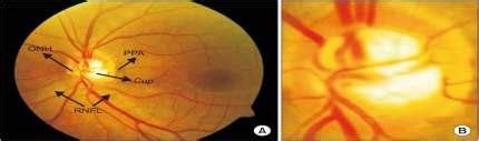 Glaucoma Detection Through Various Techniques Download Scientific Diagram